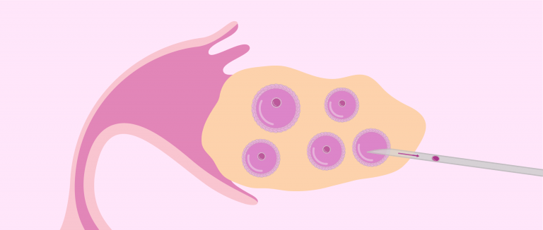 La ponction ovarienne: prélèvement des ovocytes pour une FIV