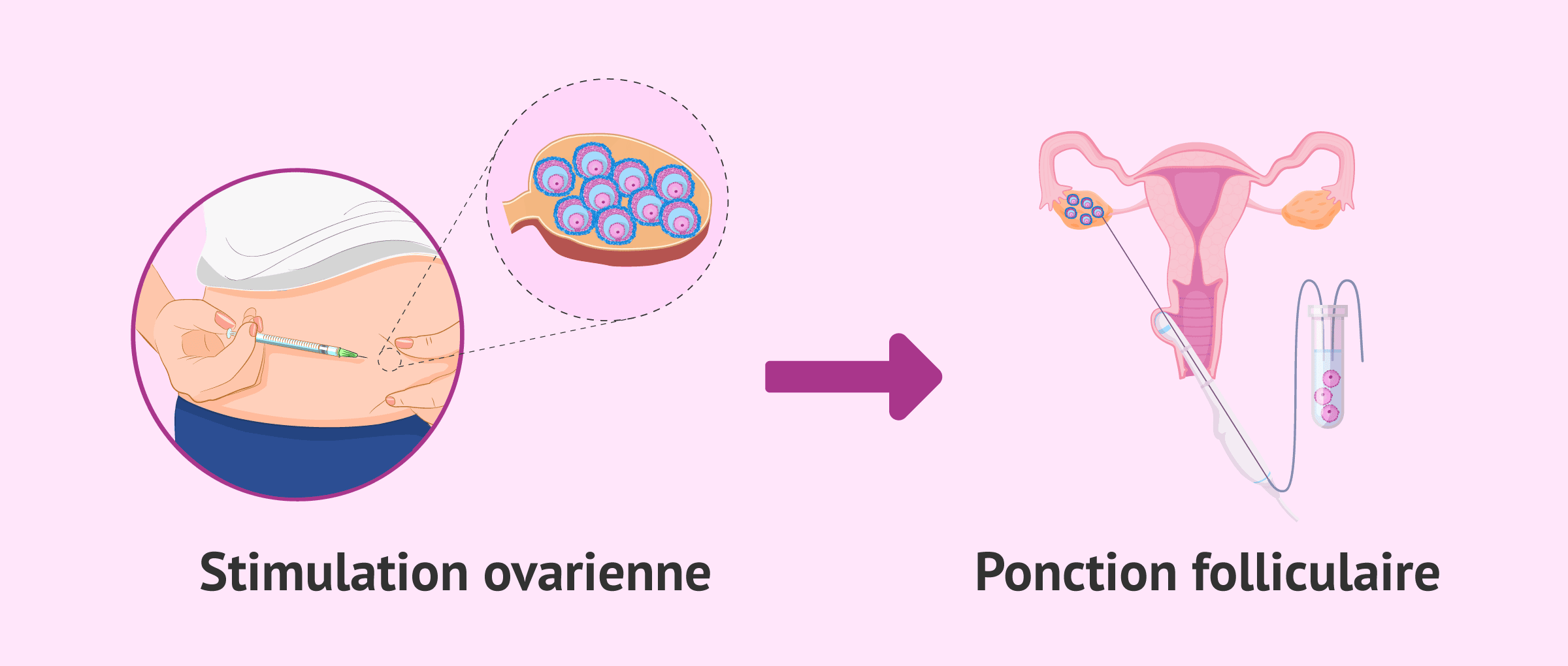 Ponction folliculaire après stimulation ovarienne