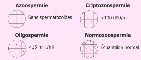 Azoospermie sécrétoire et obstructive: causes et diagnostic