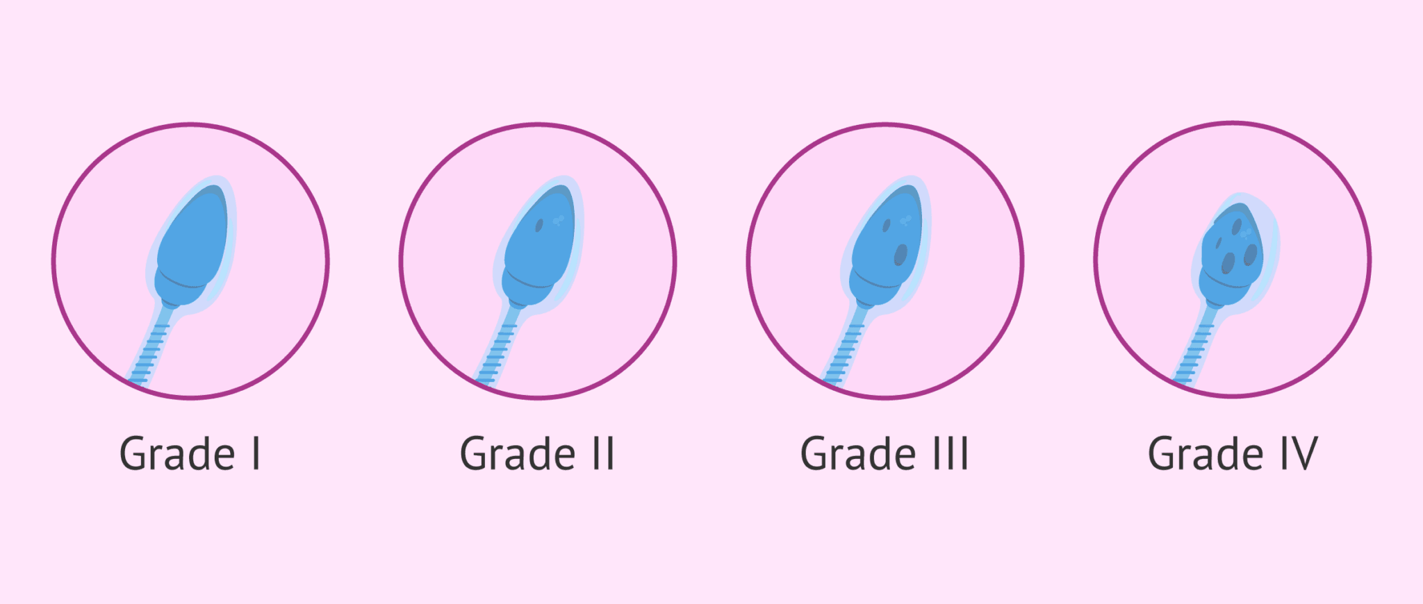 Classification des spermatozoïdes avec vacuoles