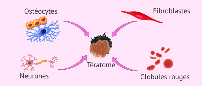 Le tératome ovarien ou kyste dermoïde ovarien: causes et traitement