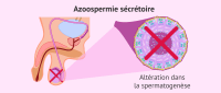 Qu'est-ce que l'azoospermie sécrétoire? - Causes et traitements