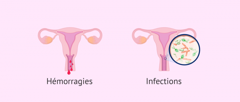 Faire un don d'ovocytes: possibles risques pour la donneuse