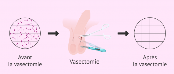 Azoospermie sécrétoire et obstructive: causes et diagnostic