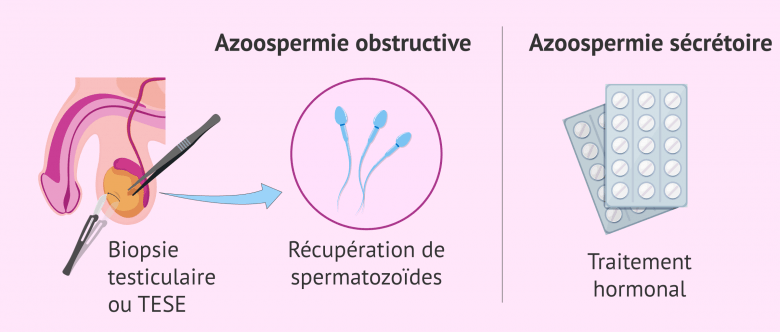 Azoospermie sécrétoire et obstructive: causes et diagnostic