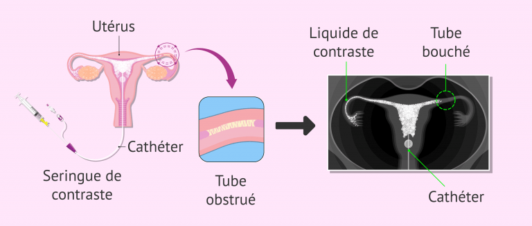 Observation des trompes de Fallope par hystérosalpingographie